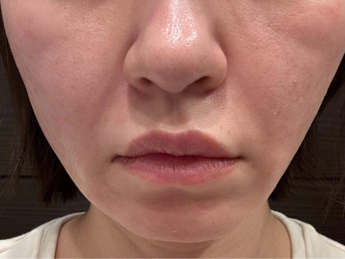 ほうれい線がない人の特徴は？ほうれい線の原因・予防法・改善方法を徹底解説 | column｜Brighte(ブライト)公式サイト